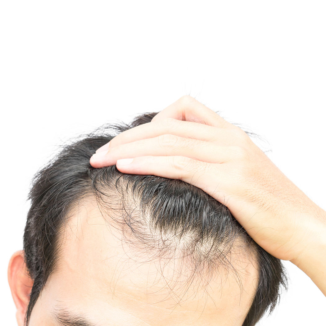 Baldness in Women - Causes & Symptoms of Baldness - Parachute Advansed